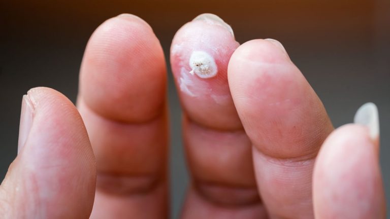 Does Frog Pee Cause Warts? [Science Explains] – Acuario Pets